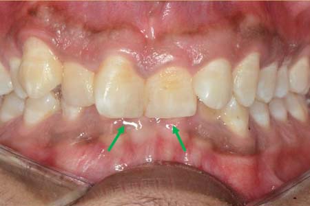 Bite Maker - EZee Braces
