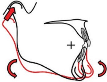Bite Maker - EZee Braces